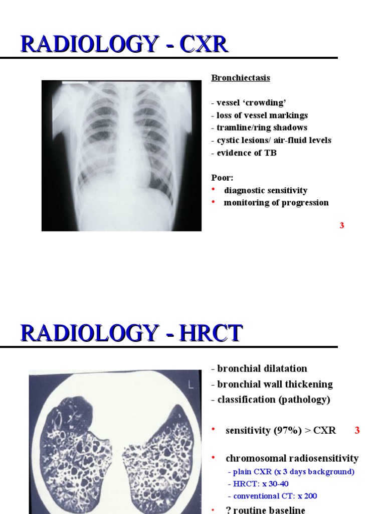 Bronchiectasis X Ray