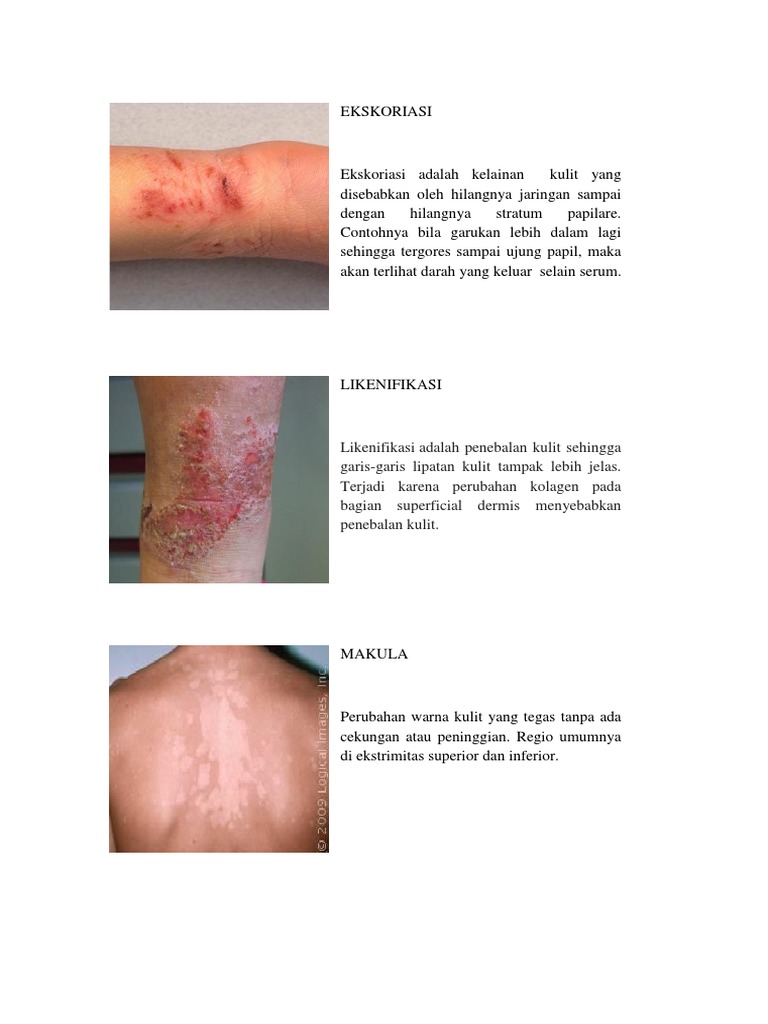 Definisi dan Jenis Ekskoriasi Kulit | PDF