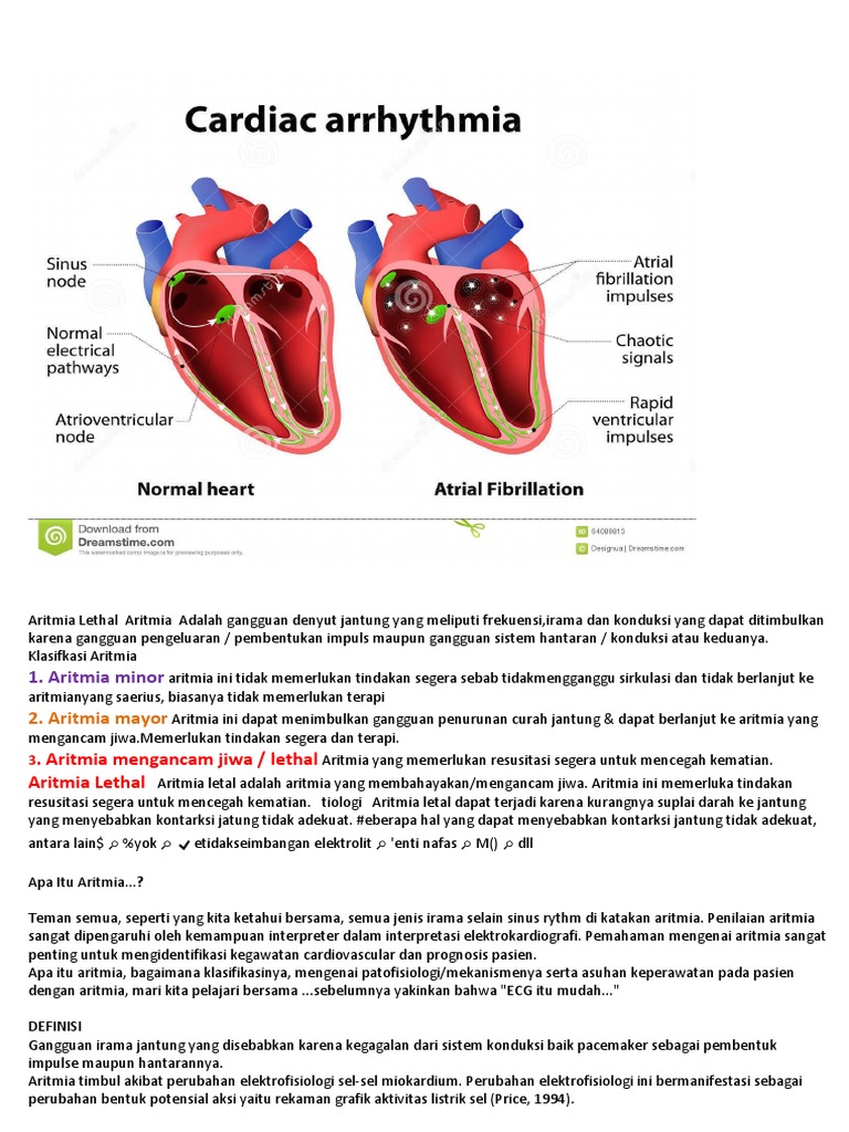Aritmia Lethal 2 | PDF