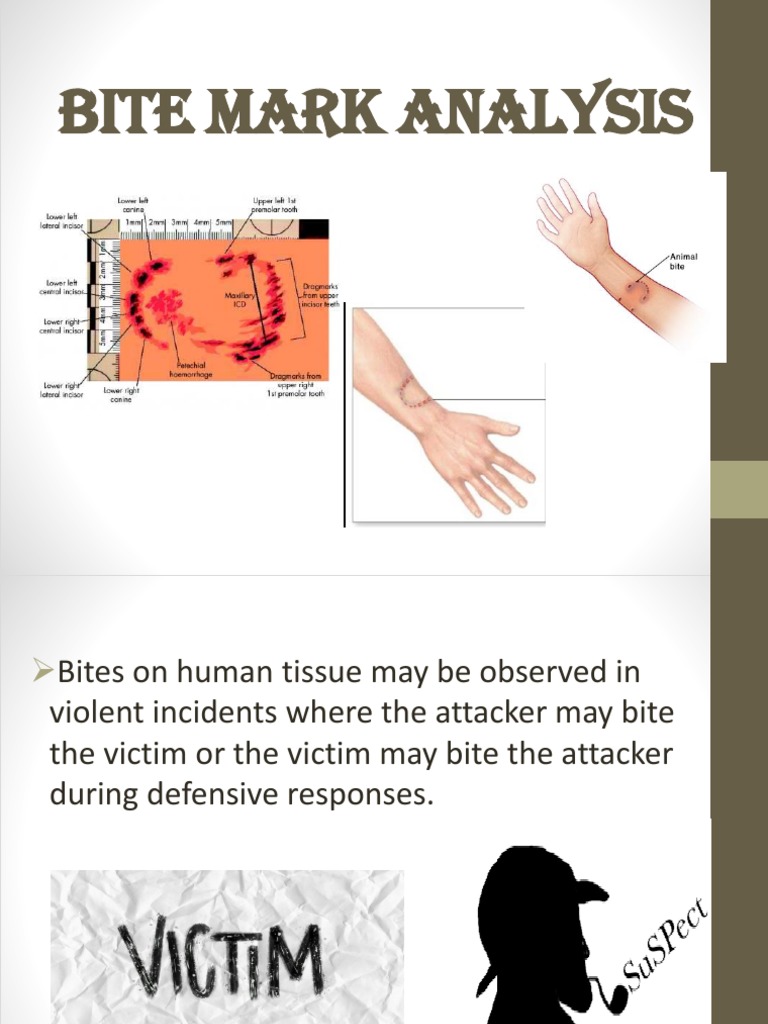 Bite Marks | PDF