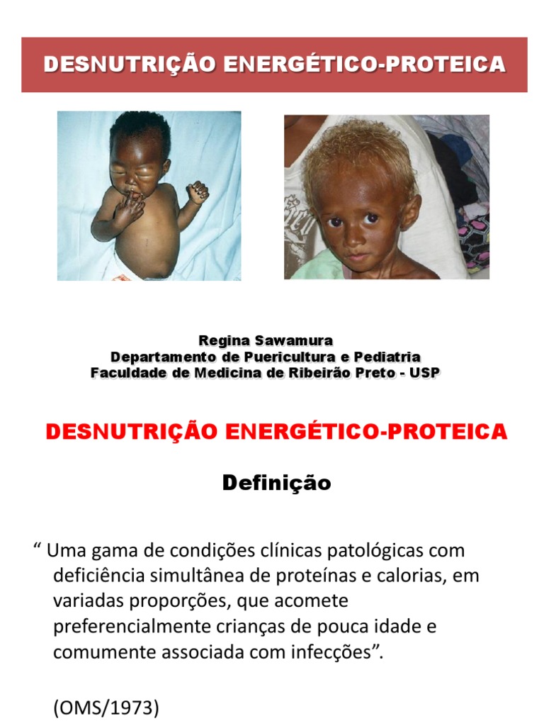 Desnutrição infantil: causas e classificações | PDF | Desnutrição ...