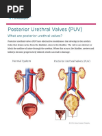 Understanding VUJ Obstruction in Kids | PDF | Urinary Bladder | Urinary ...