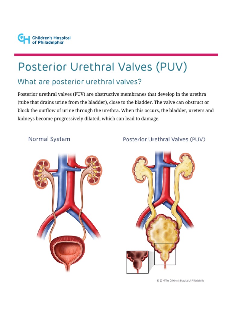 Posterior Urethral Valves (PUV) - Children's Hospital of Philadelphia ...