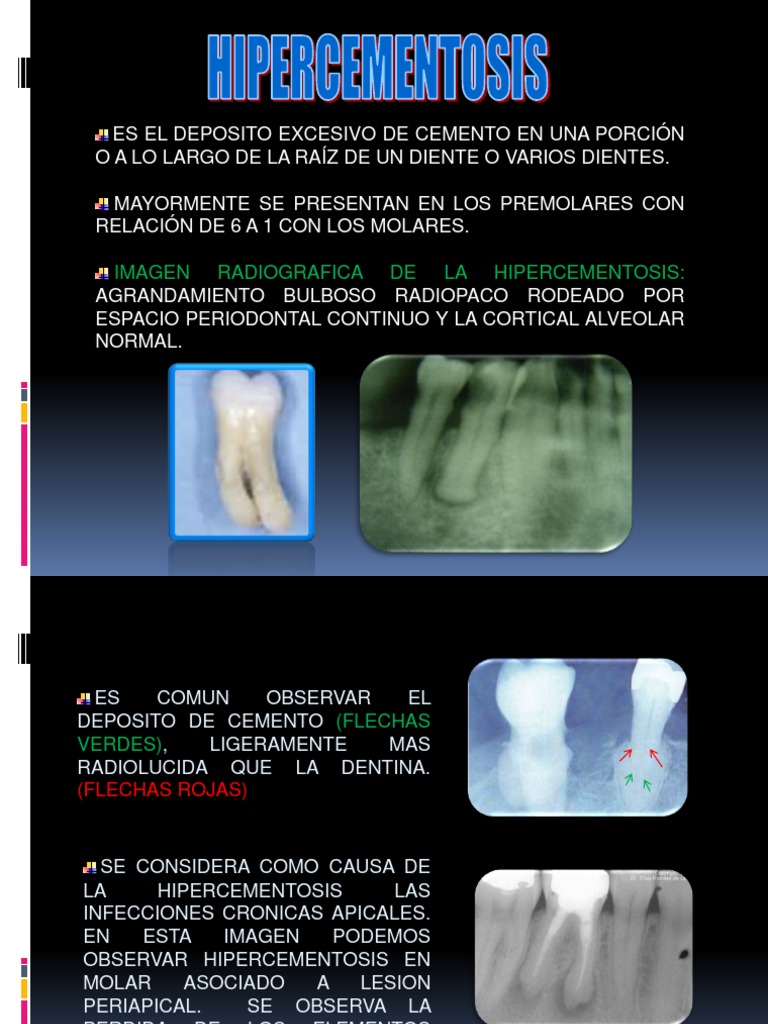 Hipercementosis y Anquilosis | PDF | Ciencia y matemáticas