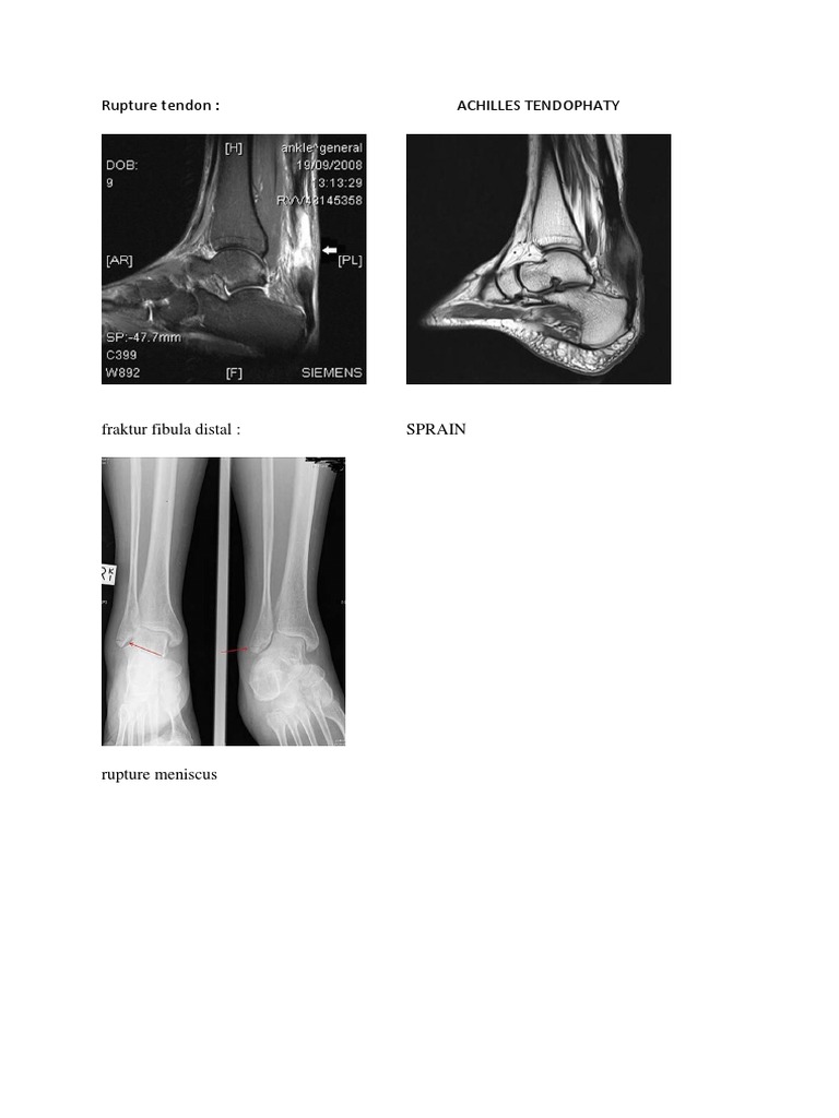 Rupture Tendon: Achilles Tendophaty | PDF