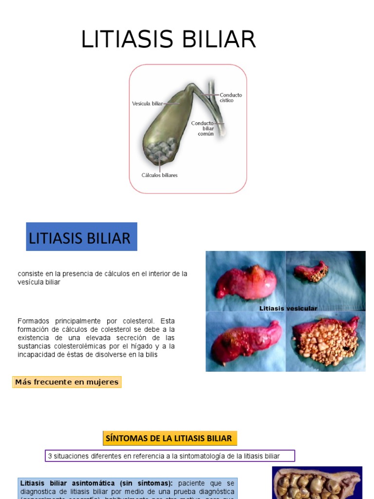 Litiasis Biliar | PDF