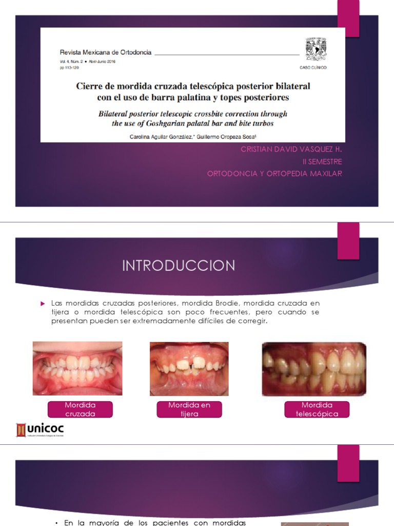 Barra Palatina Goshgarian | PDF | Ortodoncia | Ramas de Odontología