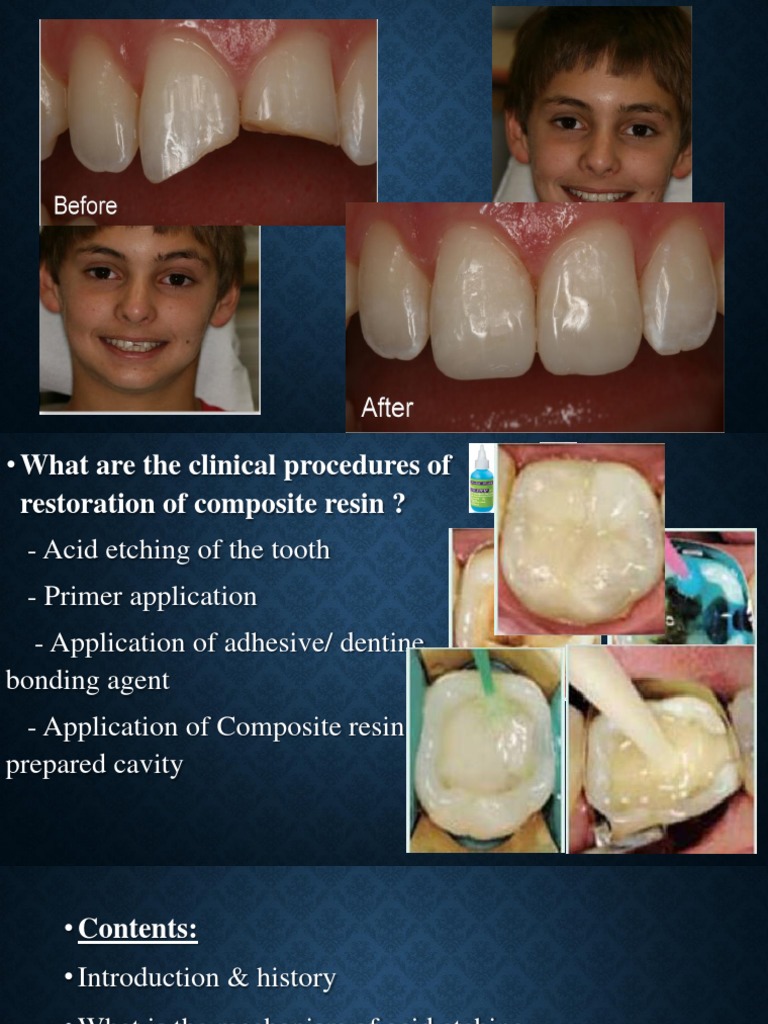 Acid Etch | PDF | Dental Composite | Dentin