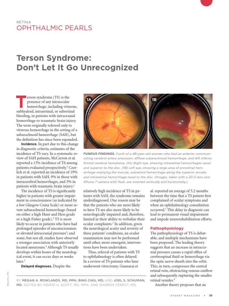 Terson Syndrome: Don't Let It Go Unrecognized: Ophthalmic Pearls | PDF | Medical Ultrasound ...