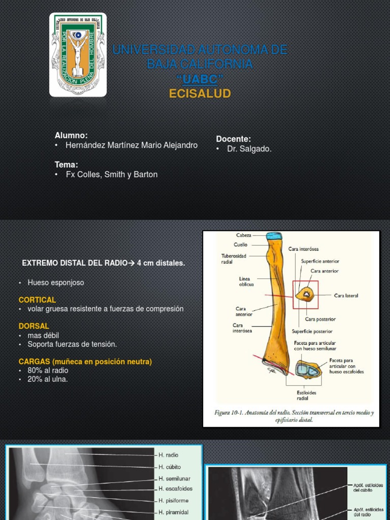 Fracturas de Colles, Smith y Barton | PDF | Traumatologia | Hueso