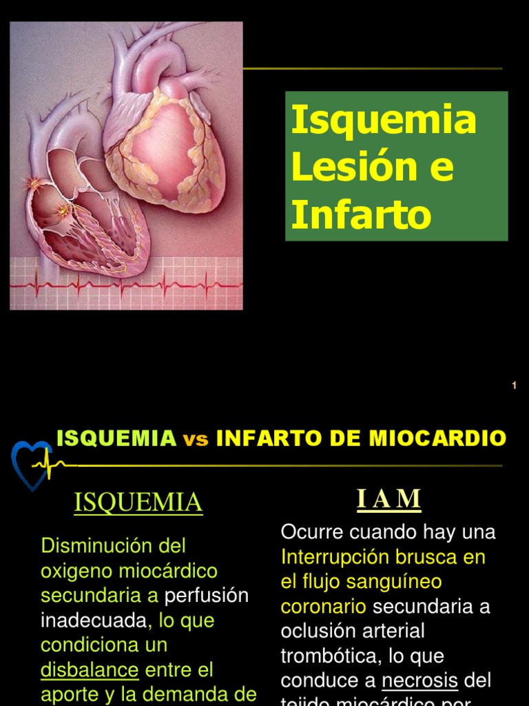Isquemia y Necrosis Miocárdica | PDF | Electrocardiografia | Infarto de ...