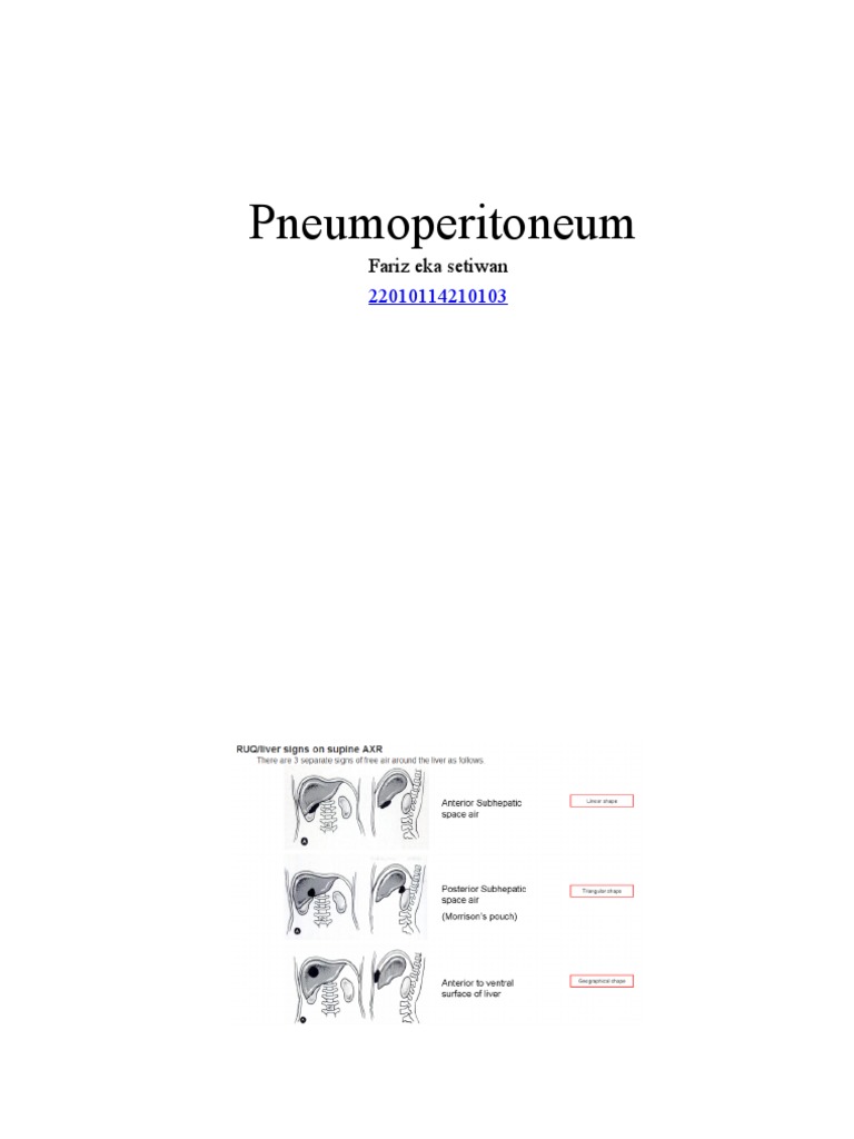 An Atlas of Radiographic Signs of Pneumoperitoneum | PDF | Peritoneum ...