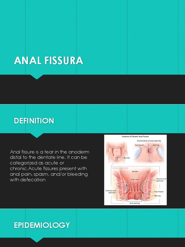 A Comprehensive Review of Anal Fissures: Definition, Epidemiology ...