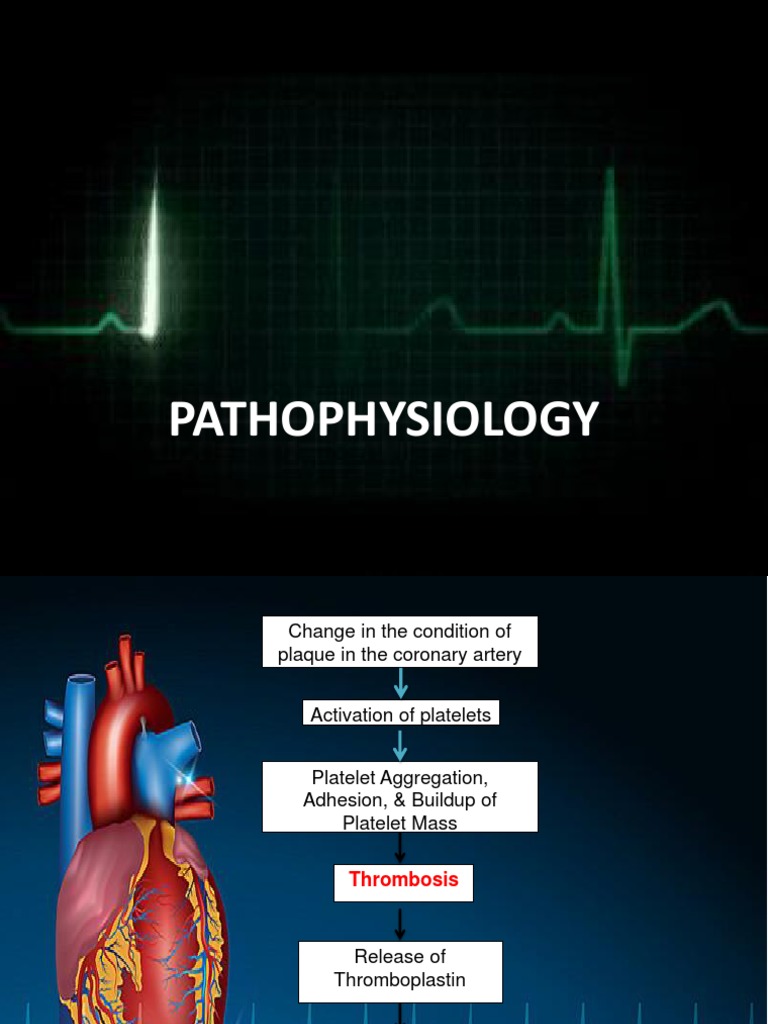 Pathophysiology Mi | PDF