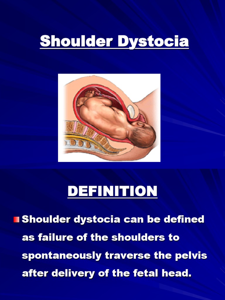 Shoulder Dystocia | PDF | Childbirth | Maternal Health