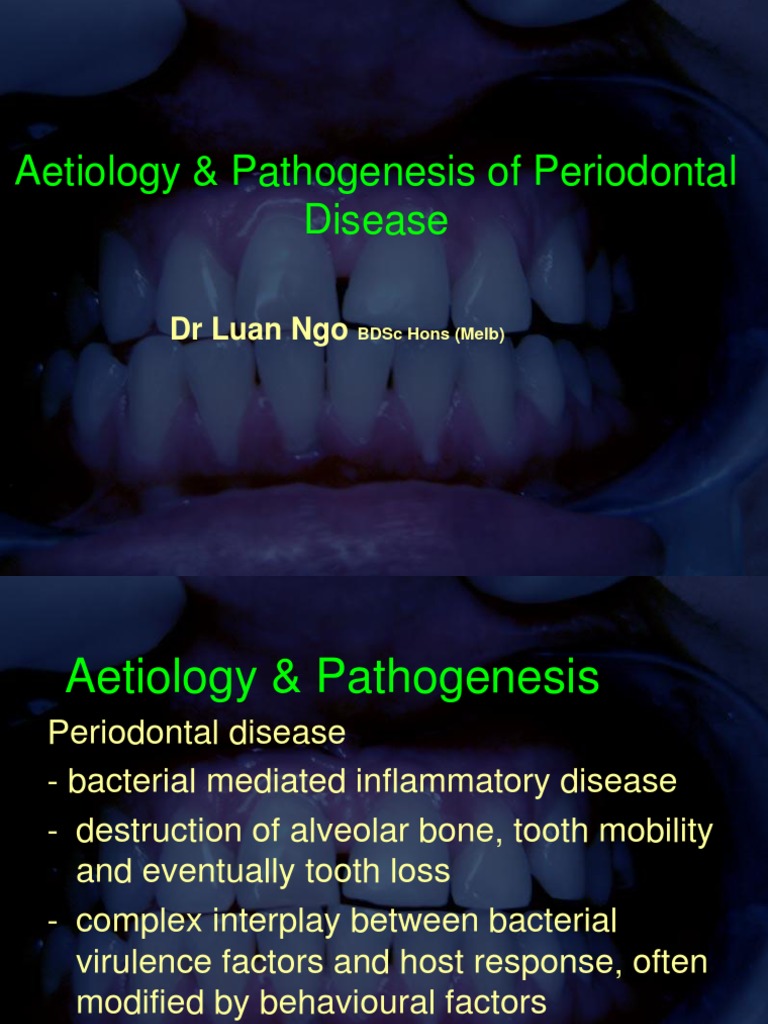 Aetiology & Pathogenesis of Periodontal Disease: DR Luan Ngo | PDF | T ...