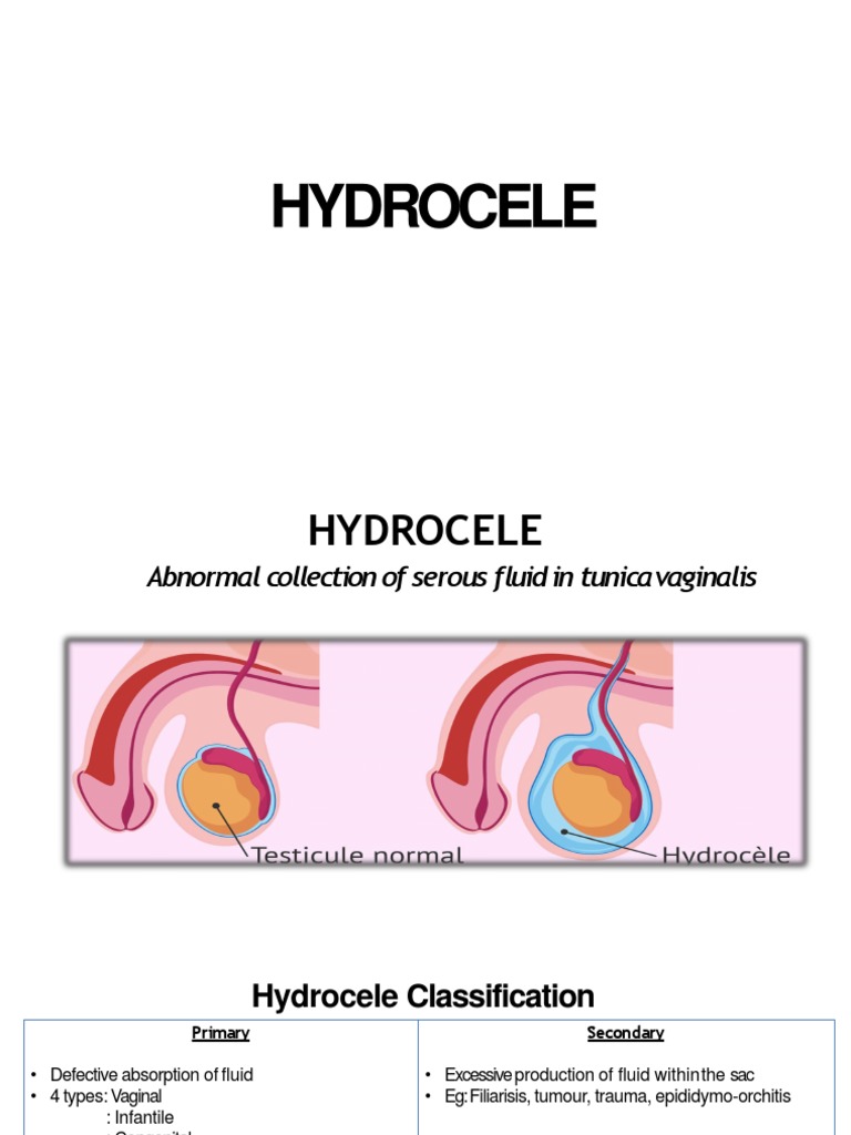 Hydrocele | PDF