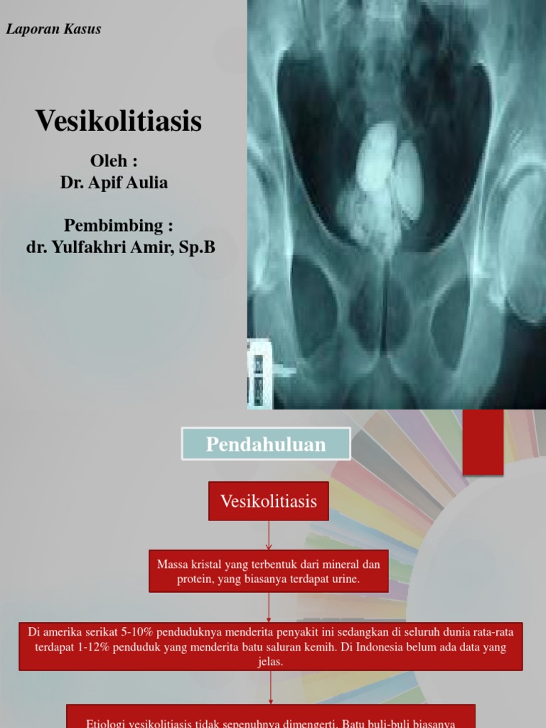 Slide Vesikolitiasis | PDF