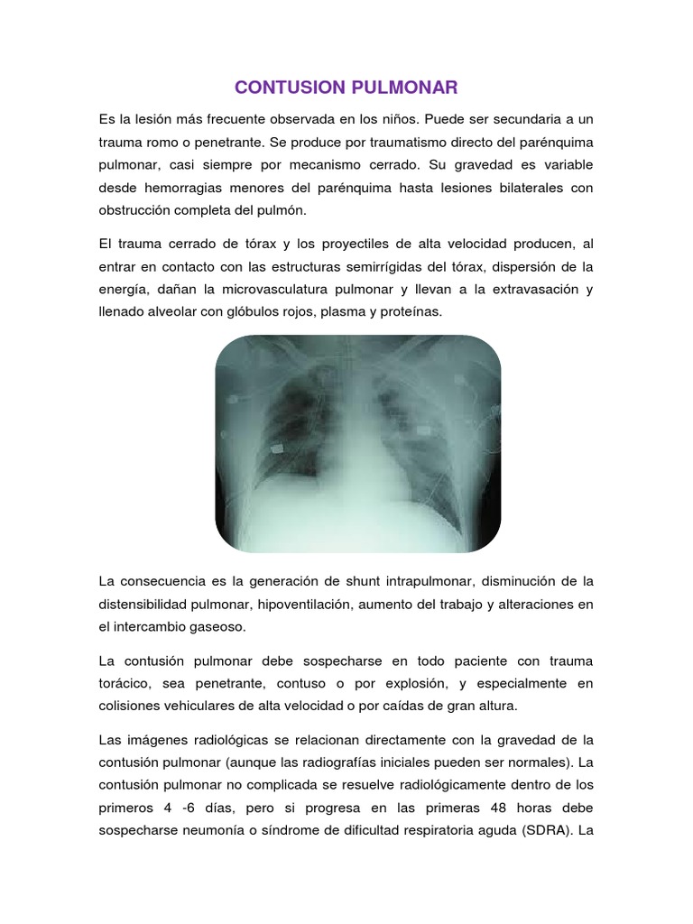 Contusion Pulmonar | PDF | Lesión | Emergencias Médicas
