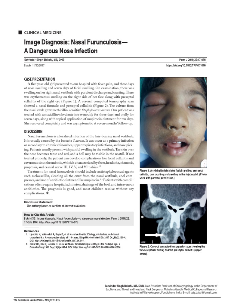 Nasal Furunculosis Infection Diagnosis | PDF | Diseases And Disorders ...