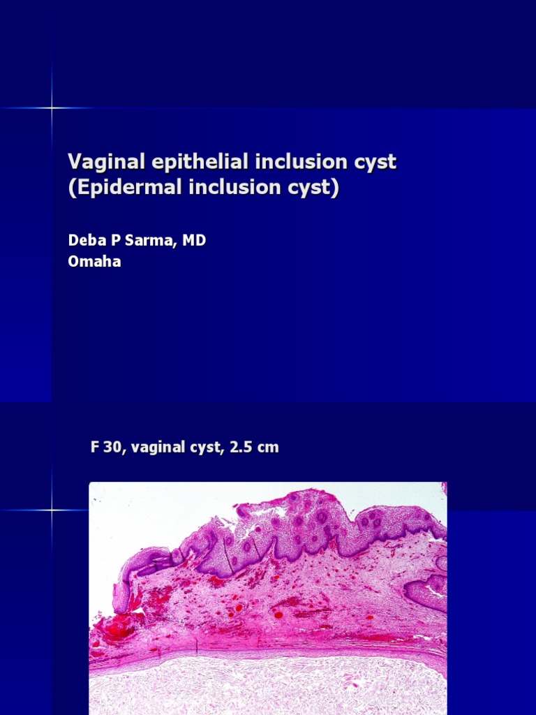 Vaginal Epithelial Inclusion Cyst, F 30, Vagina | PDF