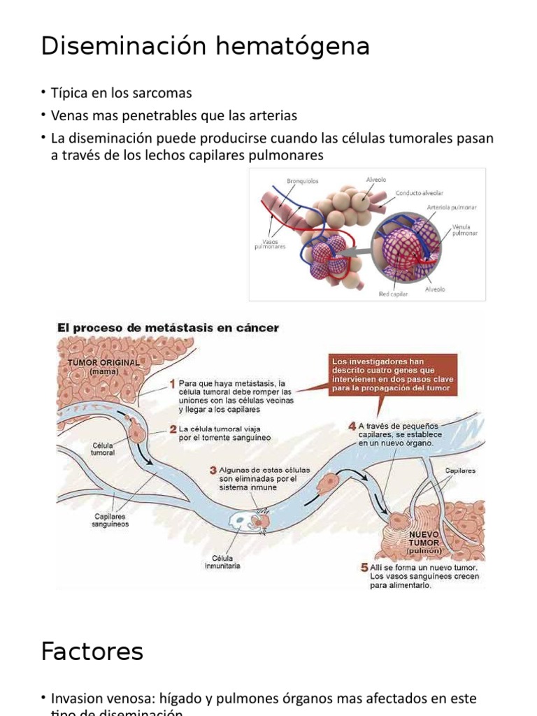 Diseminación Hematógena en Cáncer | PDF | Historia