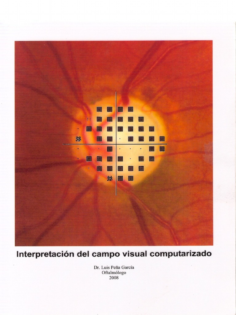 Interpretación Del Campo Visual Computarizado Peña PDF | PDF