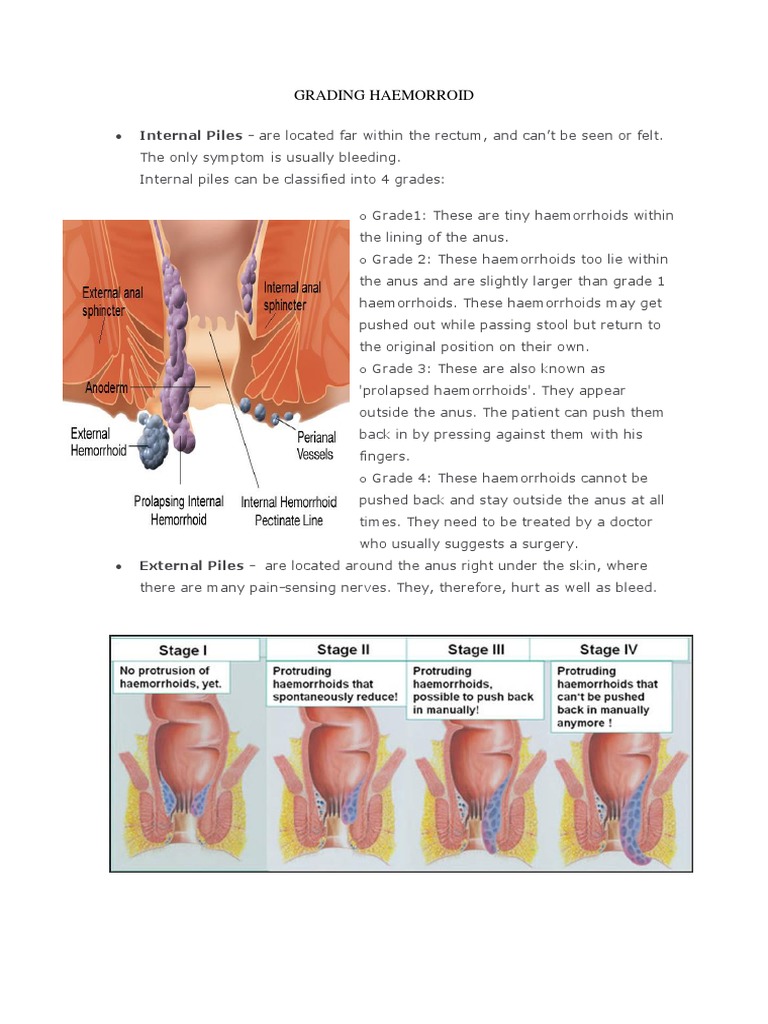 Hemorrhoid Grading System Explained | PDF
