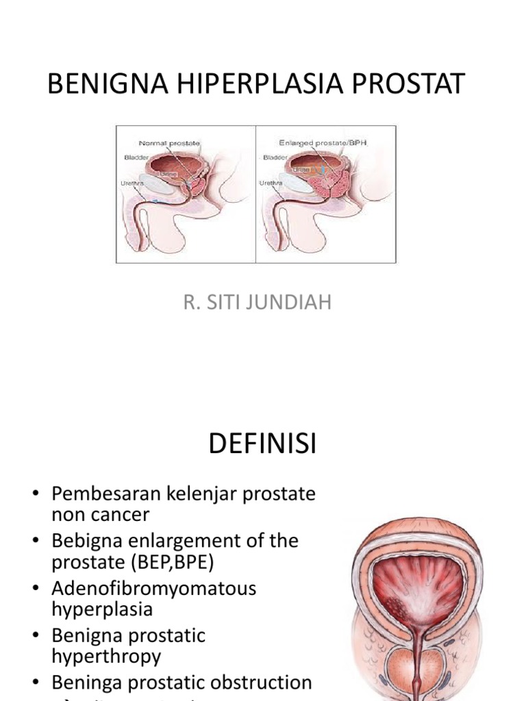 Benigna Hiperplasia Prostat | PDF | Prostate | Urinary Incontinence