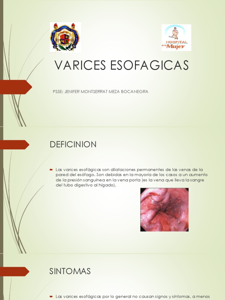 Varices Esofagicas | PDF | Endoscopia | Venas varicosas
