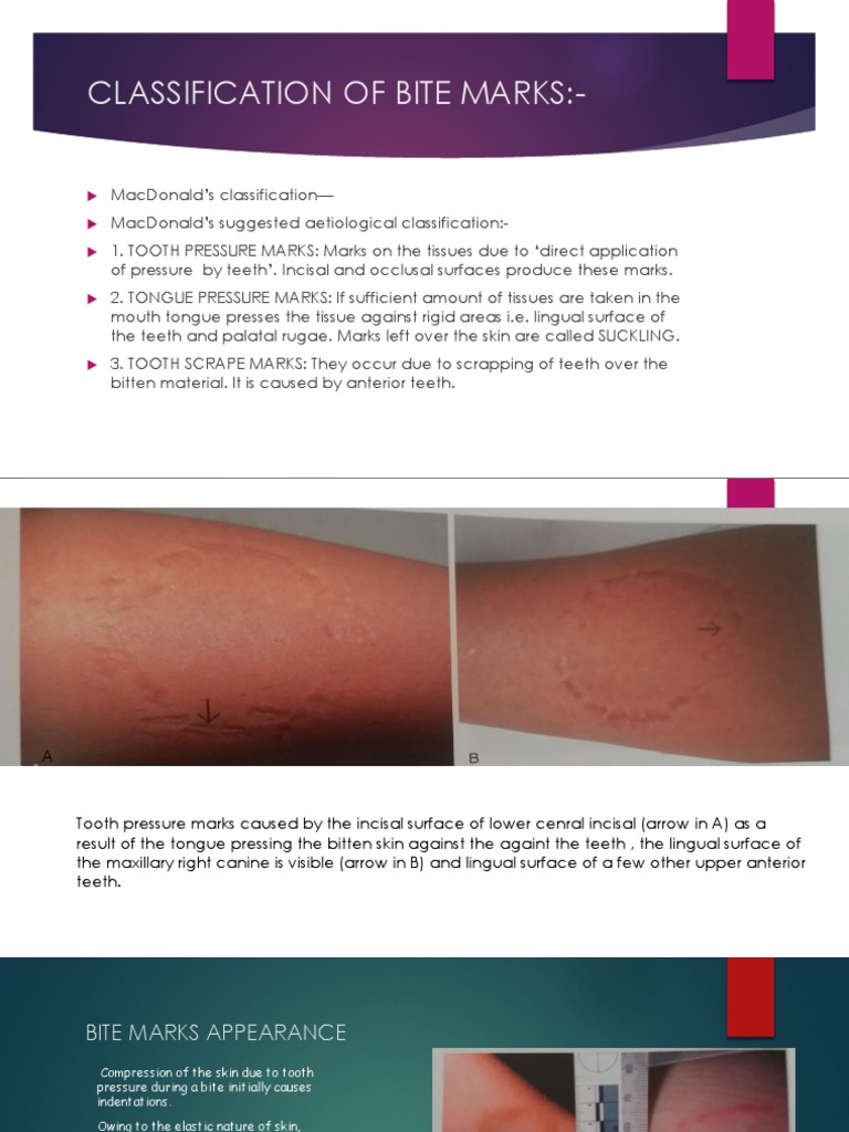Bite Marks Classification Overview | PDF | Tooth | Human Anatomy