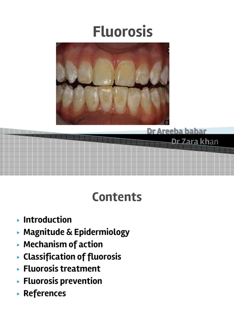 Causes and Prevention of Fluorosis | PDF | Tooth Enamel | Dentistry