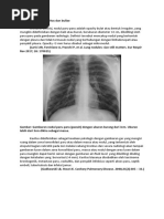 Anatomi Thorax Normal + Gambaran Radiologi | PDF