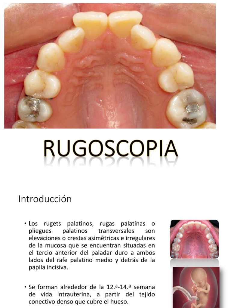 rugoscopia | Curva | Dentadura postiza