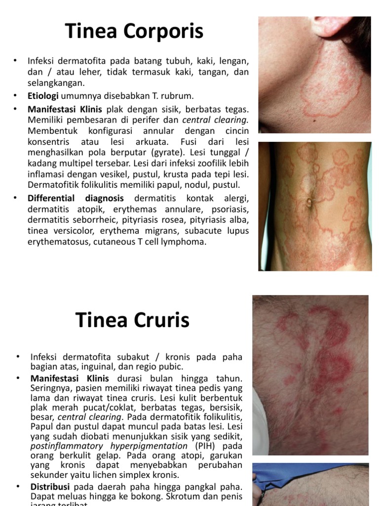 Tinea Corporis Dan Cruris | PDF