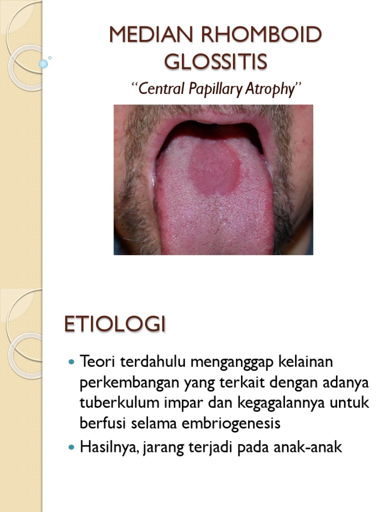 Median Rhomboid Glossitis | PDF