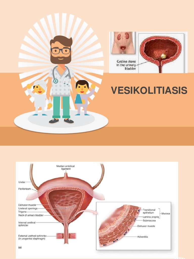 VESICOLITHIASIS | PDF | Urinary Bladder | Surgical Specialties