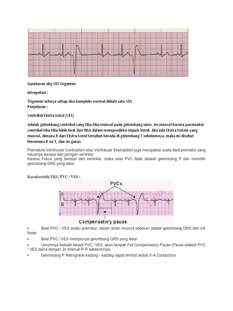Gambaran Ekg VES Trigemini | PDF