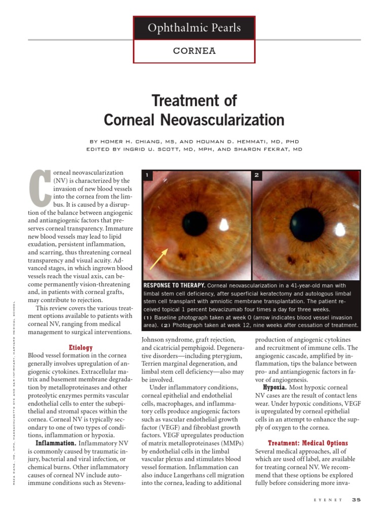 October 2013 Ophthalmic Pearls | PDF | Angiogenesis | Cornea