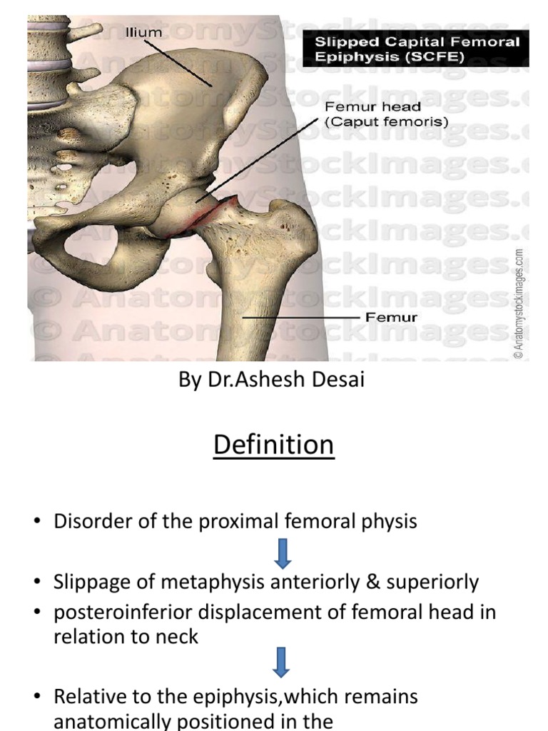 Epiphysis Of Neck Of Femur