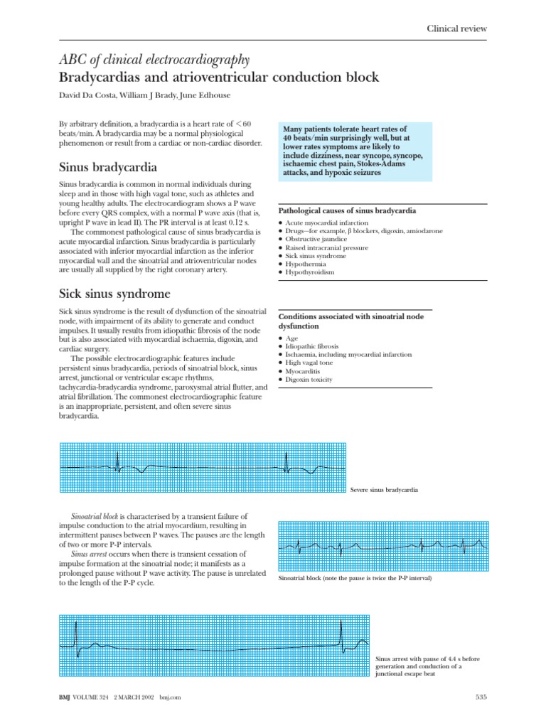 Bradycardia Avb | PDF | Electrocardiography | Cardiovascular Diseases