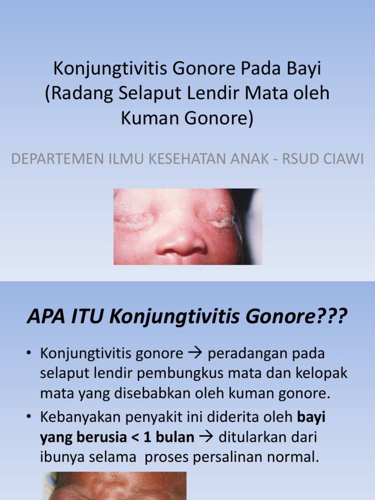 Konjungtivitis Gonore | PDF
