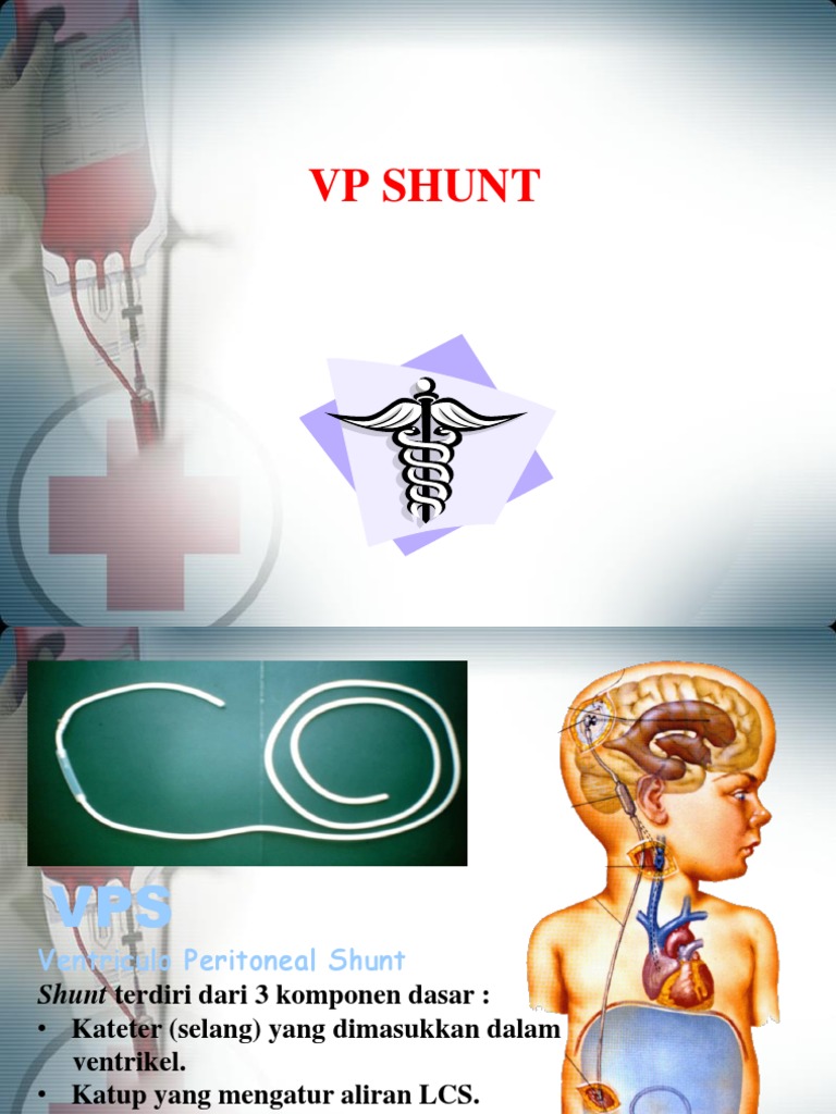 VP Shunt | PDF