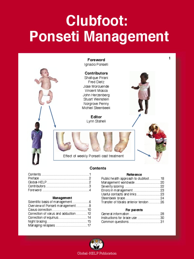Ponsetti Method | PDF | Foot | Lower Limb Anatomy