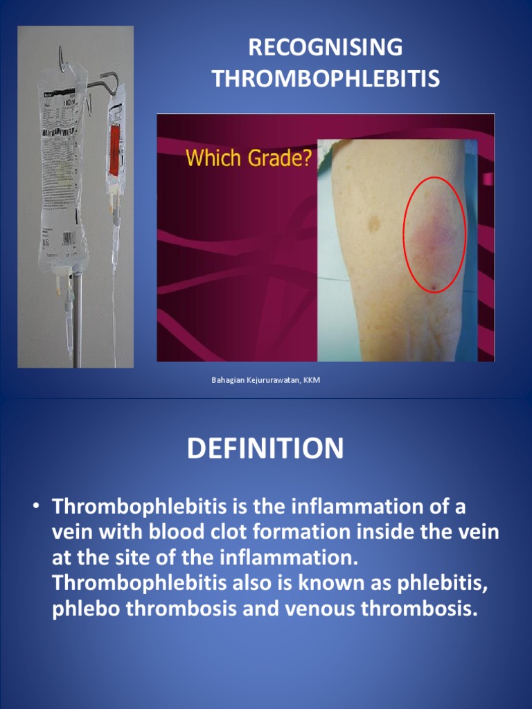 Thrombophlebitis Recognition and Care | PDF | Intravenous Therapy ...