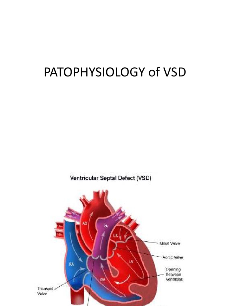 Understanding VSD Pathophysiology | PDF