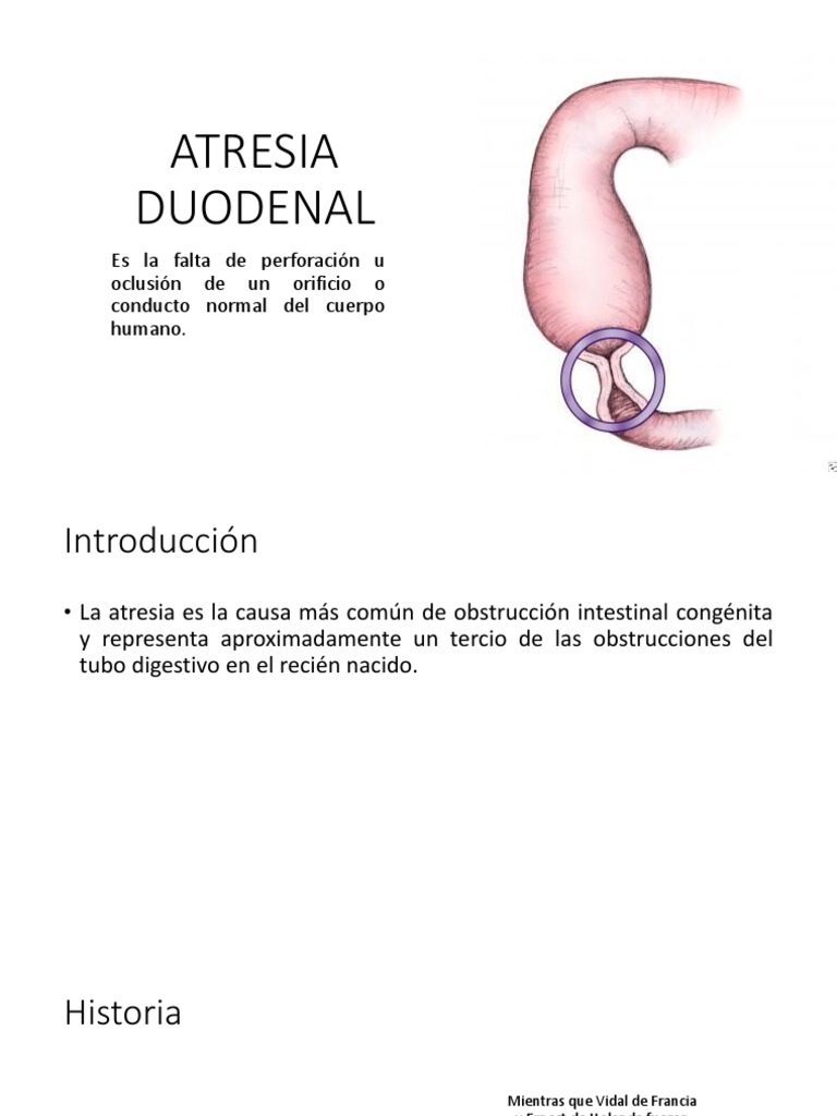 Atresia Duodenal | PDF | Síndrome de Down | Abdomen