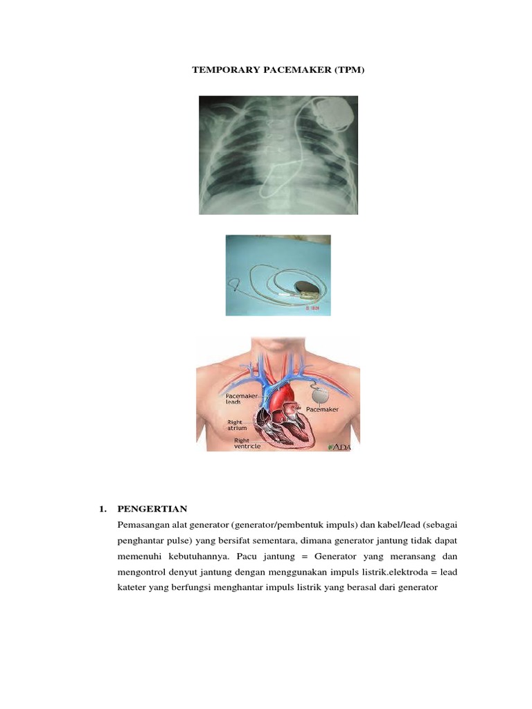 Temporary Pacemaker | PDF