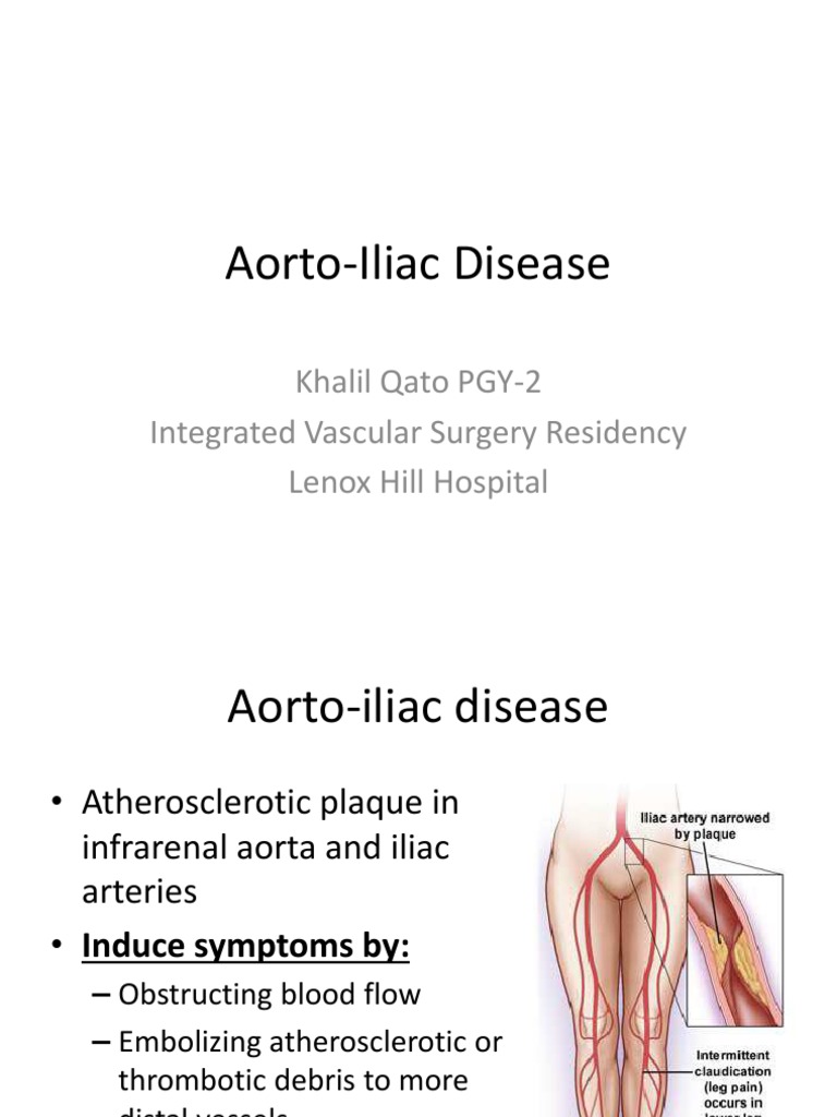 Aorto Iliac Disease | Aorta | Atherosclerosis