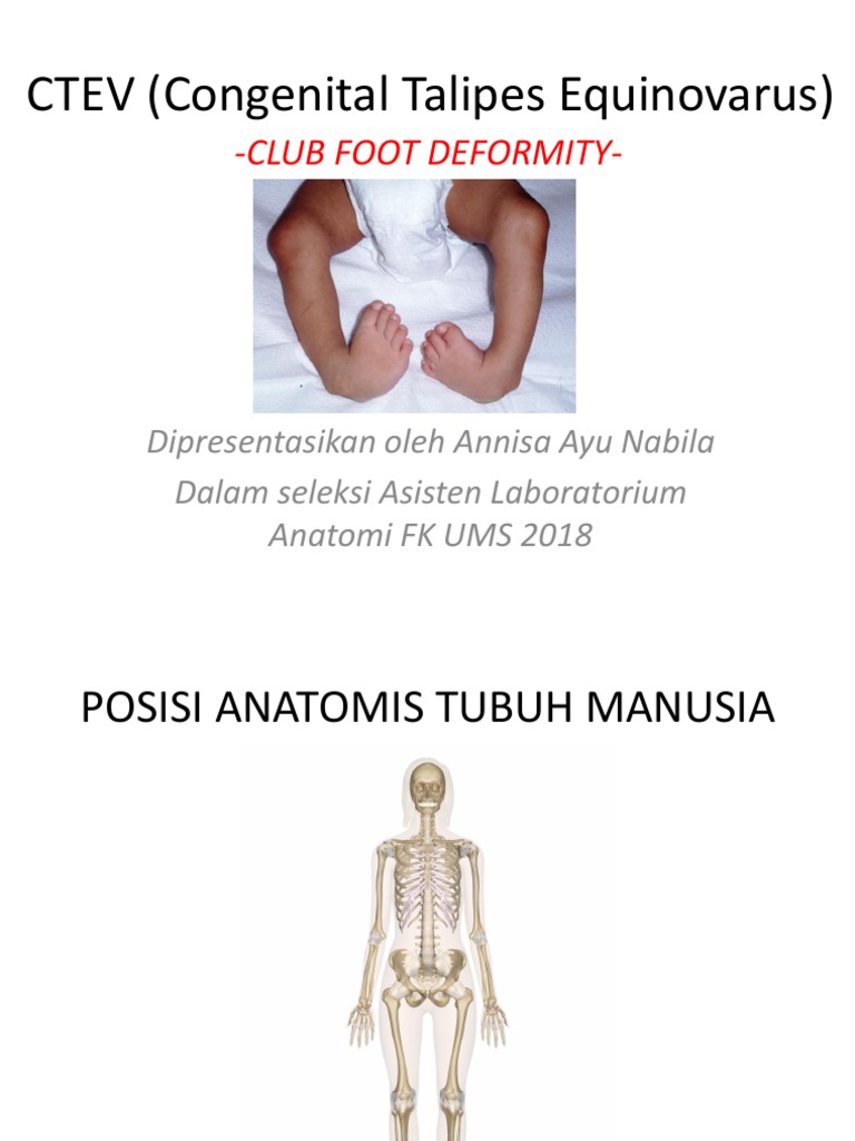 CTEV: Definisi dan Penanganan Clubfoot | PDF